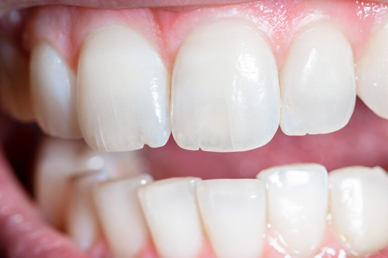 Cracked tooth - causes and treatment methods