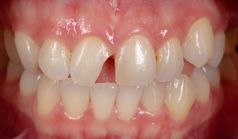 Chipped Tooth – Causes and Treatment Methods