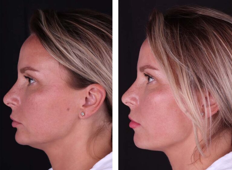 TMJ treatment TMD at TMJ dentist in Miami, Sunny Isles